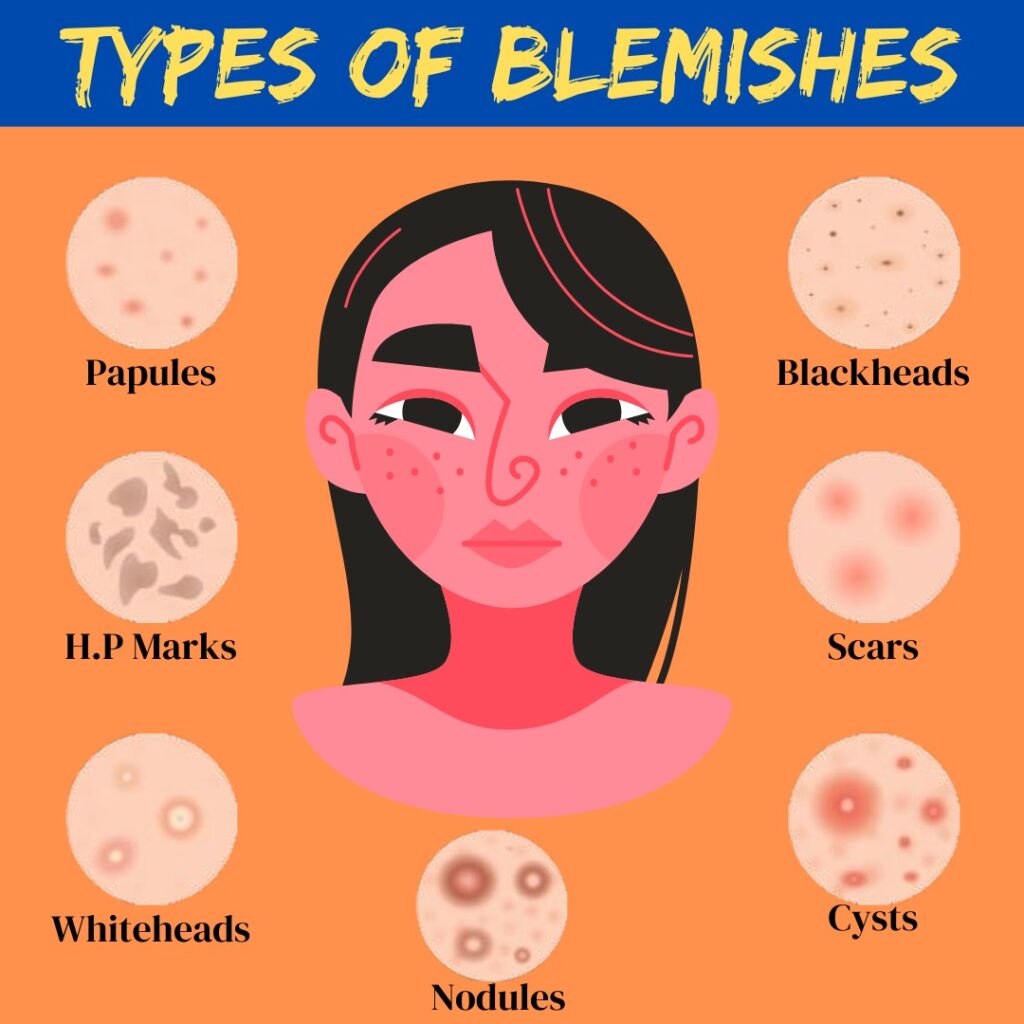 Blemishes: Symptoms, Treatment & Causes - Dr. Chhabra